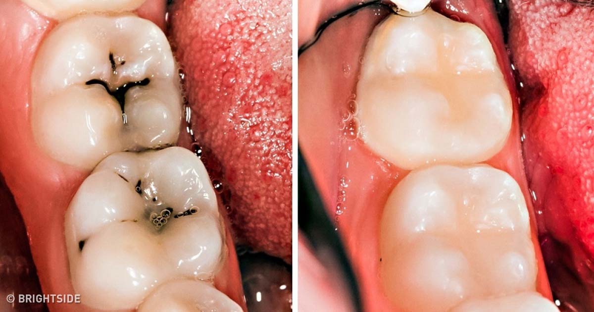 Como remover las caries negras de los dientes sin tener que hacerte ...