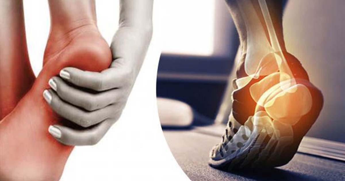Remedio natural para aliviar el dolor de talón sin esfuerzo y sin ...